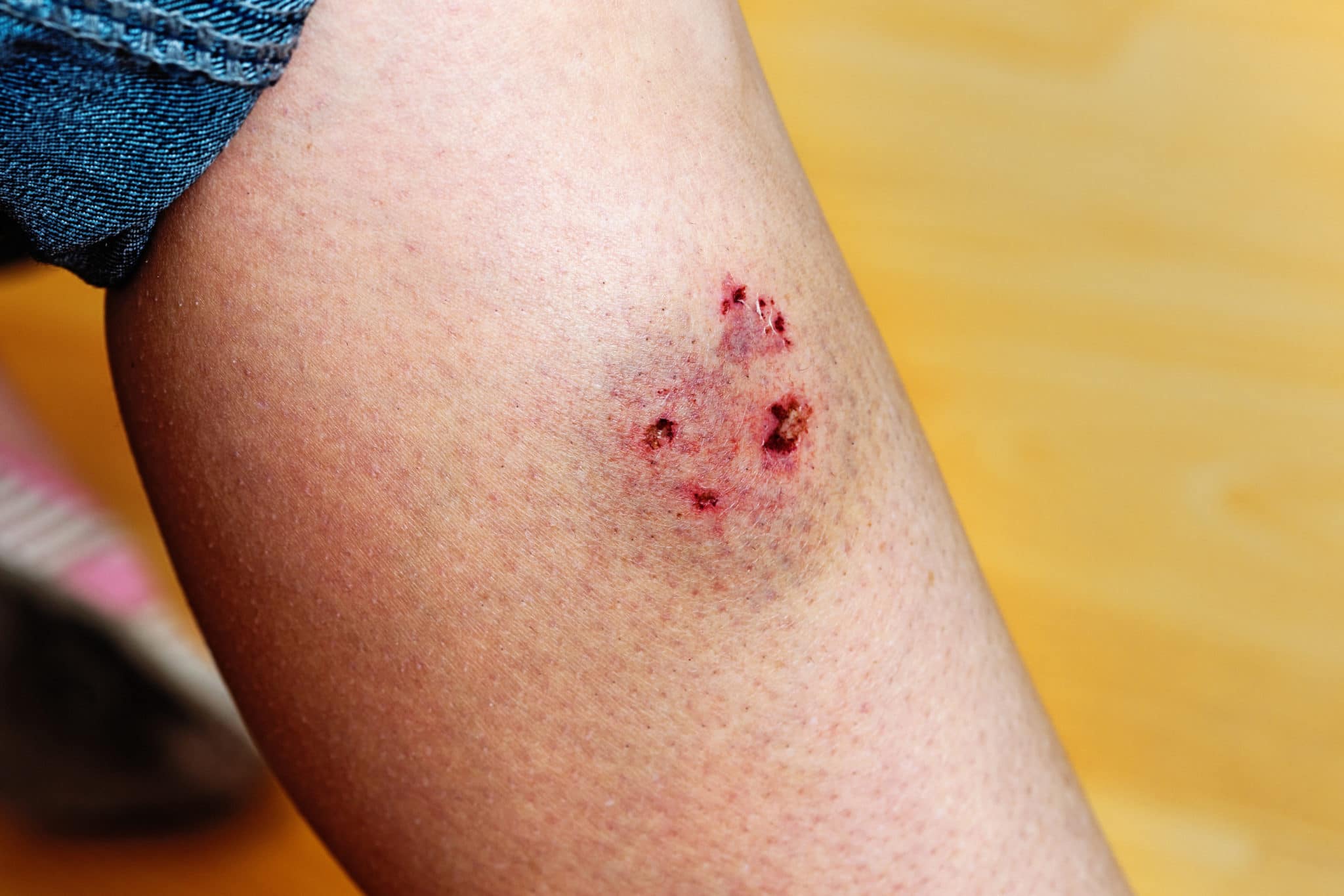 Caring for Your Dog Bite Injury | Denver, CO | Pushchak Law